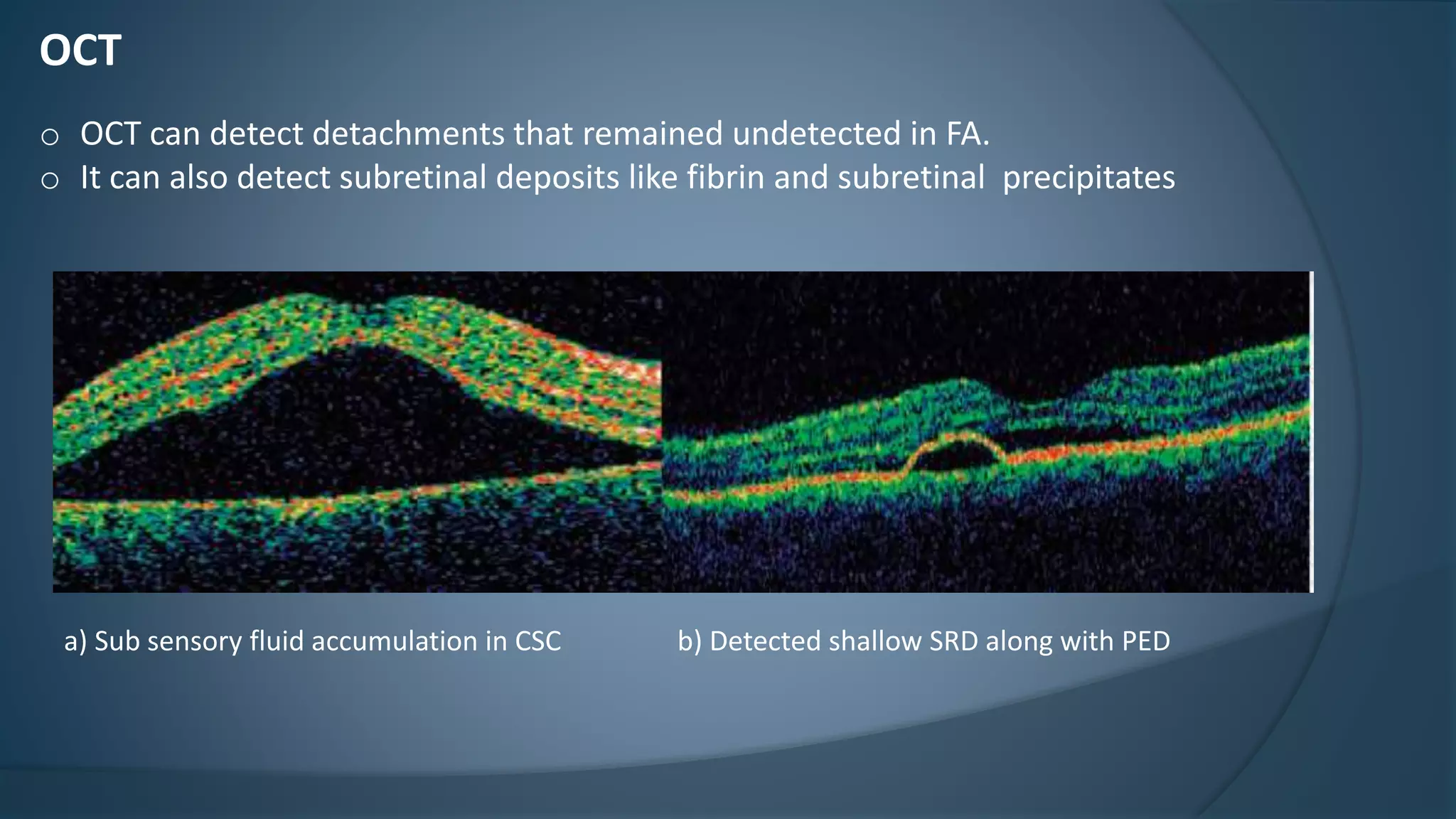 Central Serous Retinopathy | PPTX