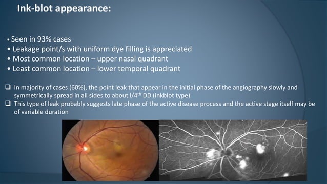 Central Serous Retinopathy | PPTX | Eye and Vision Conditions ...