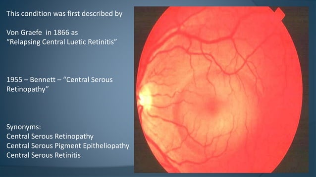 Central Serous Retinopathy | PPTX | Eye and Vision Conditions ...