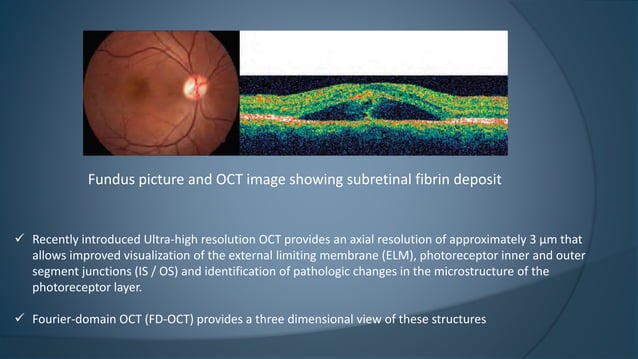 Central Serous Retinopathy | PPTX | Eye and Vision Conditions ...