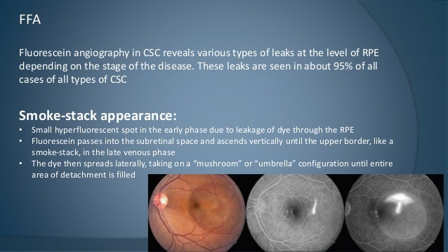 Central Serous Retinopathy