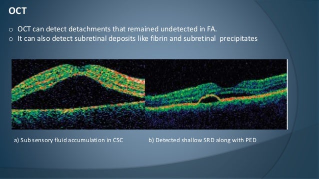 Central Serous Retinopathy