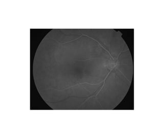 Central Serous Chorioretinopathy | PPT