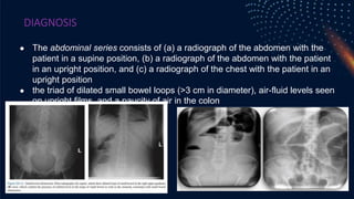 Clinical Science Session - Ileus Obstruktif | PPT