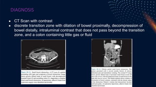 Clinical Science Session - Ileus Obstruktif | PPT