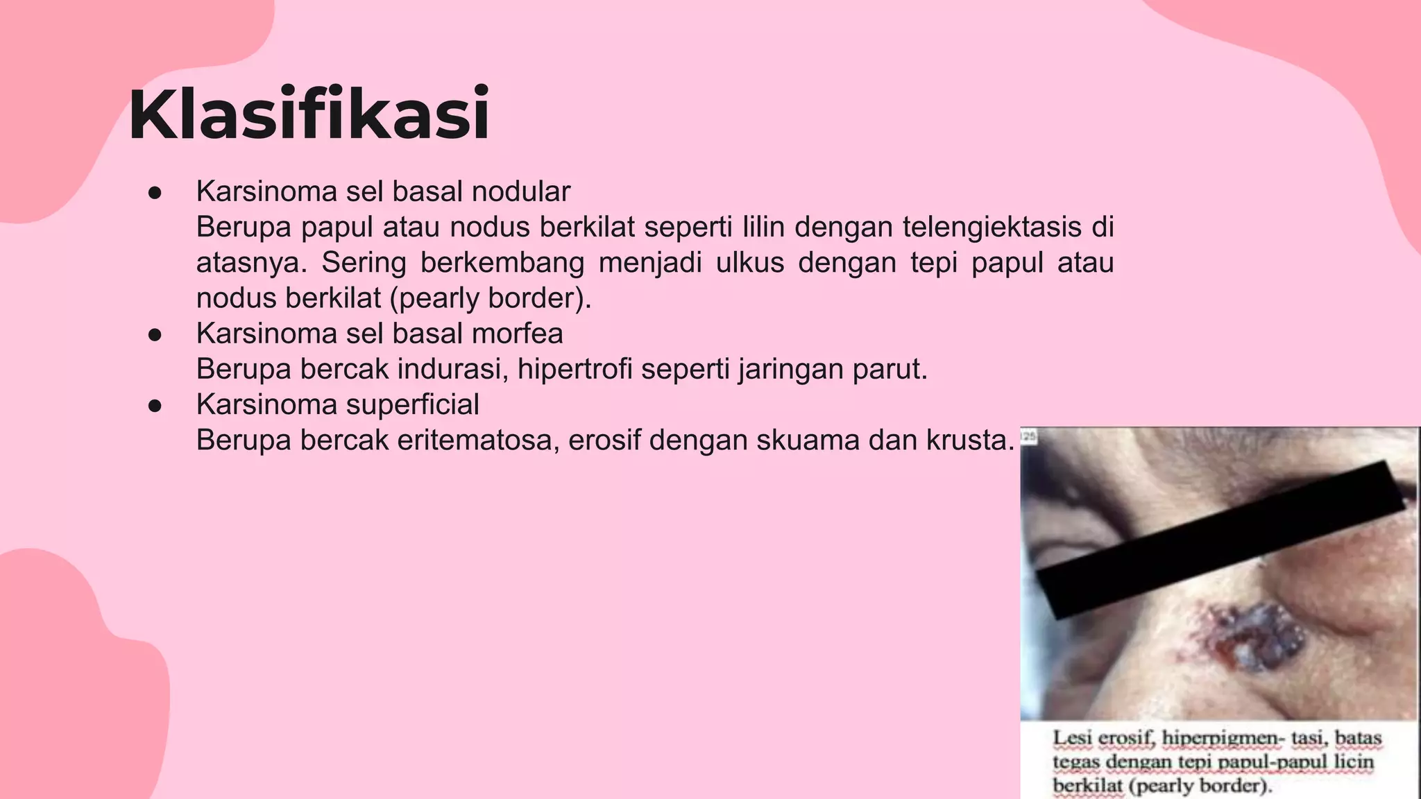 CSS 4 - Kanker Kulit.pptx