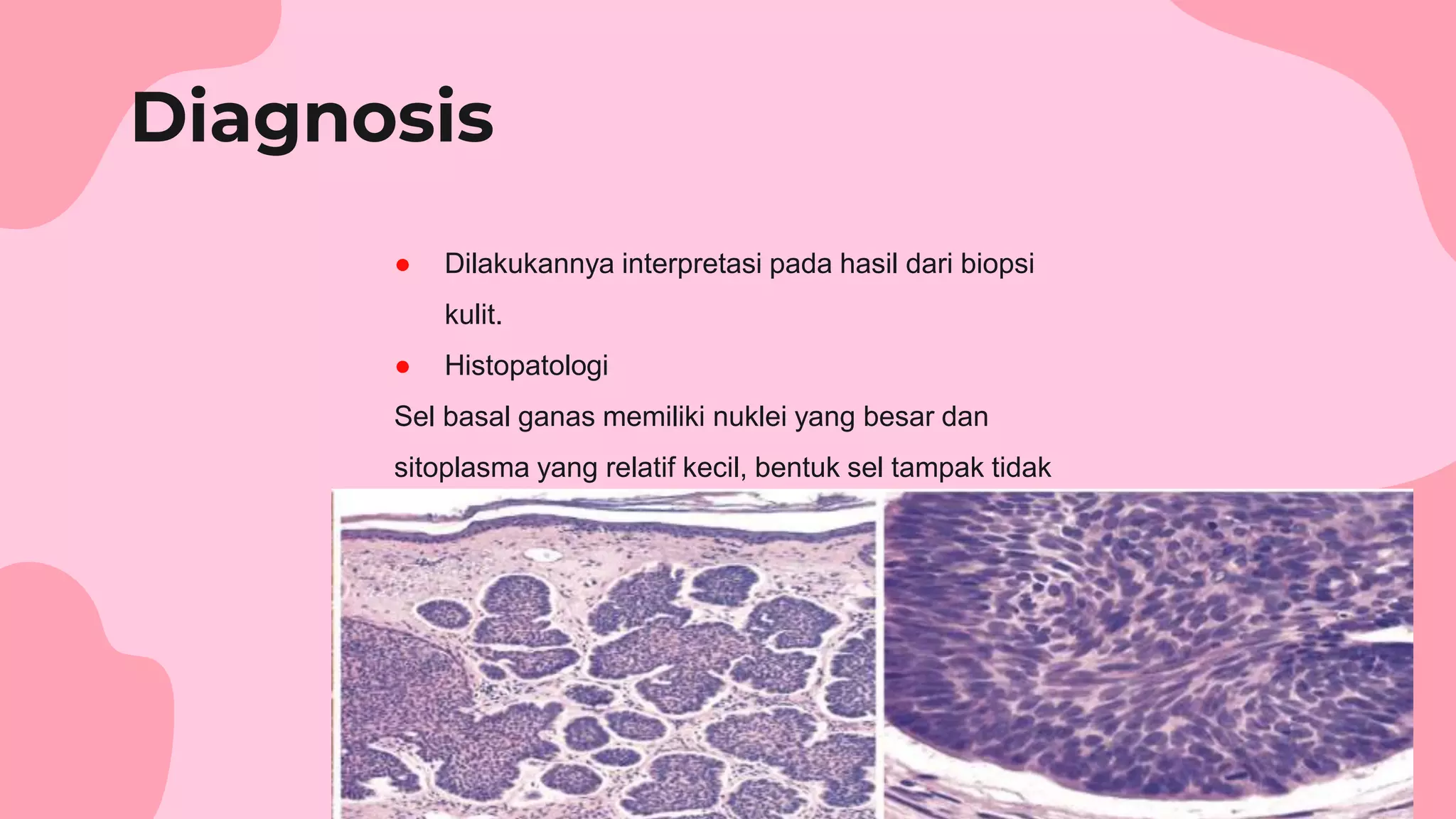 CSS 4 - Kanker Kulit.pptx