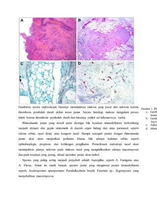 CSS Rhinosinusitis Jamur (Gerasimos Hasiholan) | DOCX