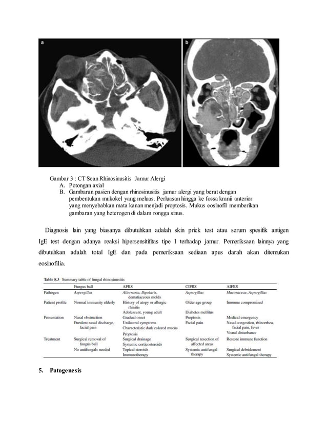 CSS Rhinosinusitis Jamur (Gerasimos Hasiholan) | PDF