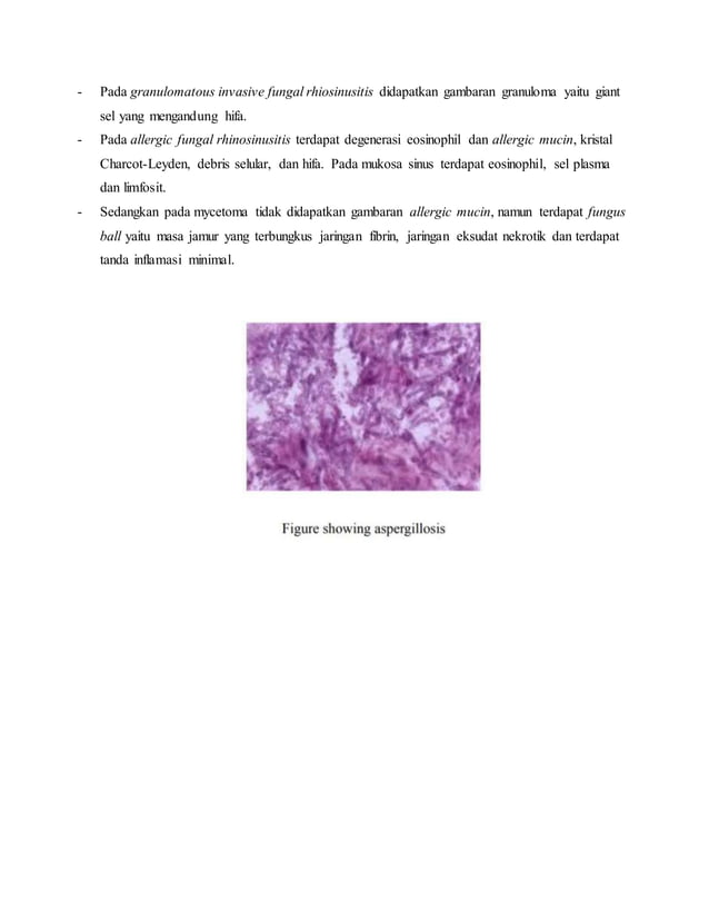 CSS Rhinosinusitis Jamur (Gerasimos Hasiholan) | PDF