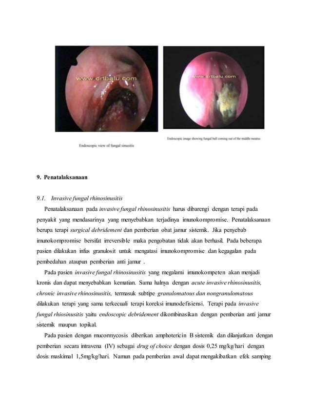 CSS Rhinosinusitis Jamur (Gerasimos Hasiholan) | PDF