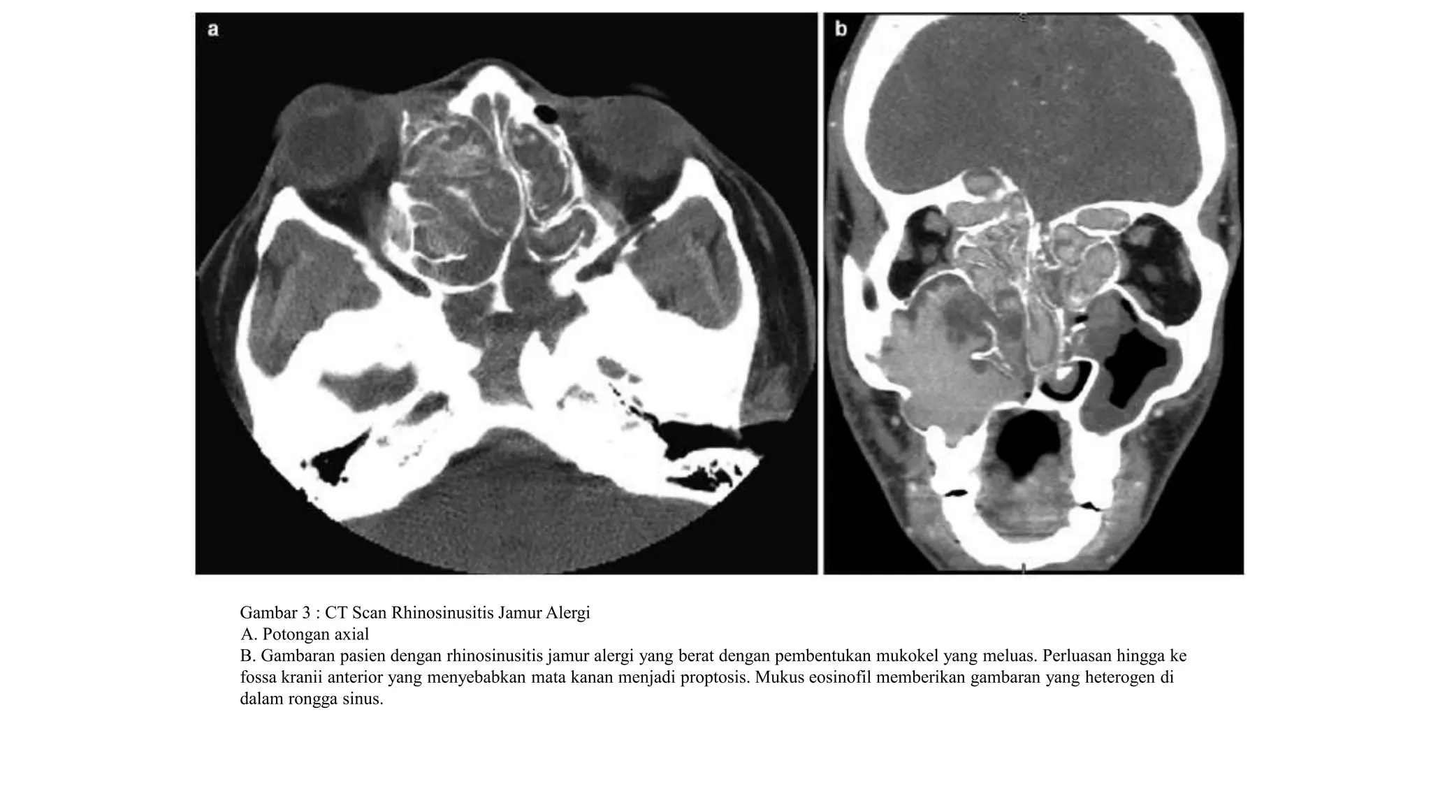 Powerpoint CSS Rhinosinusitis Jamur (Gerasimos Hasiholan) | PPTX