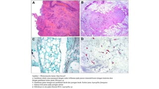 Css rhinosinusitis jamur | PPTX