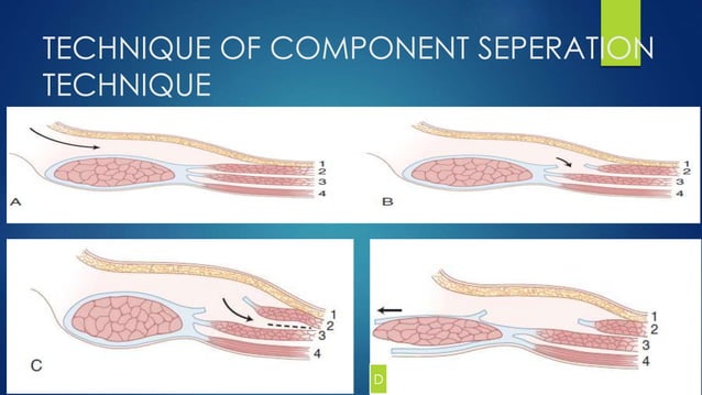 Component seperation technique for the repair of very large ventral hernias