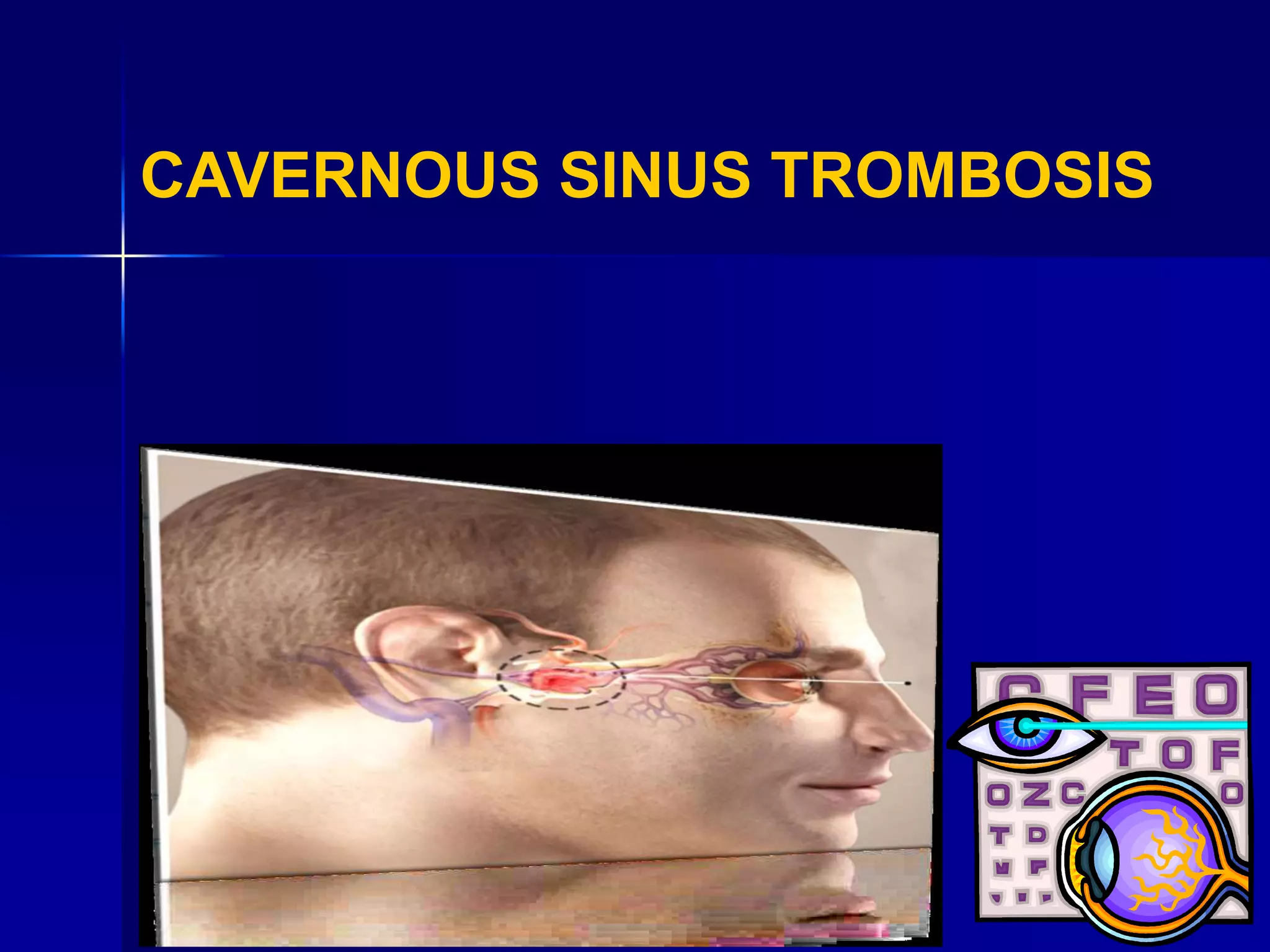 Cavernous sinus thrombosis | PPT