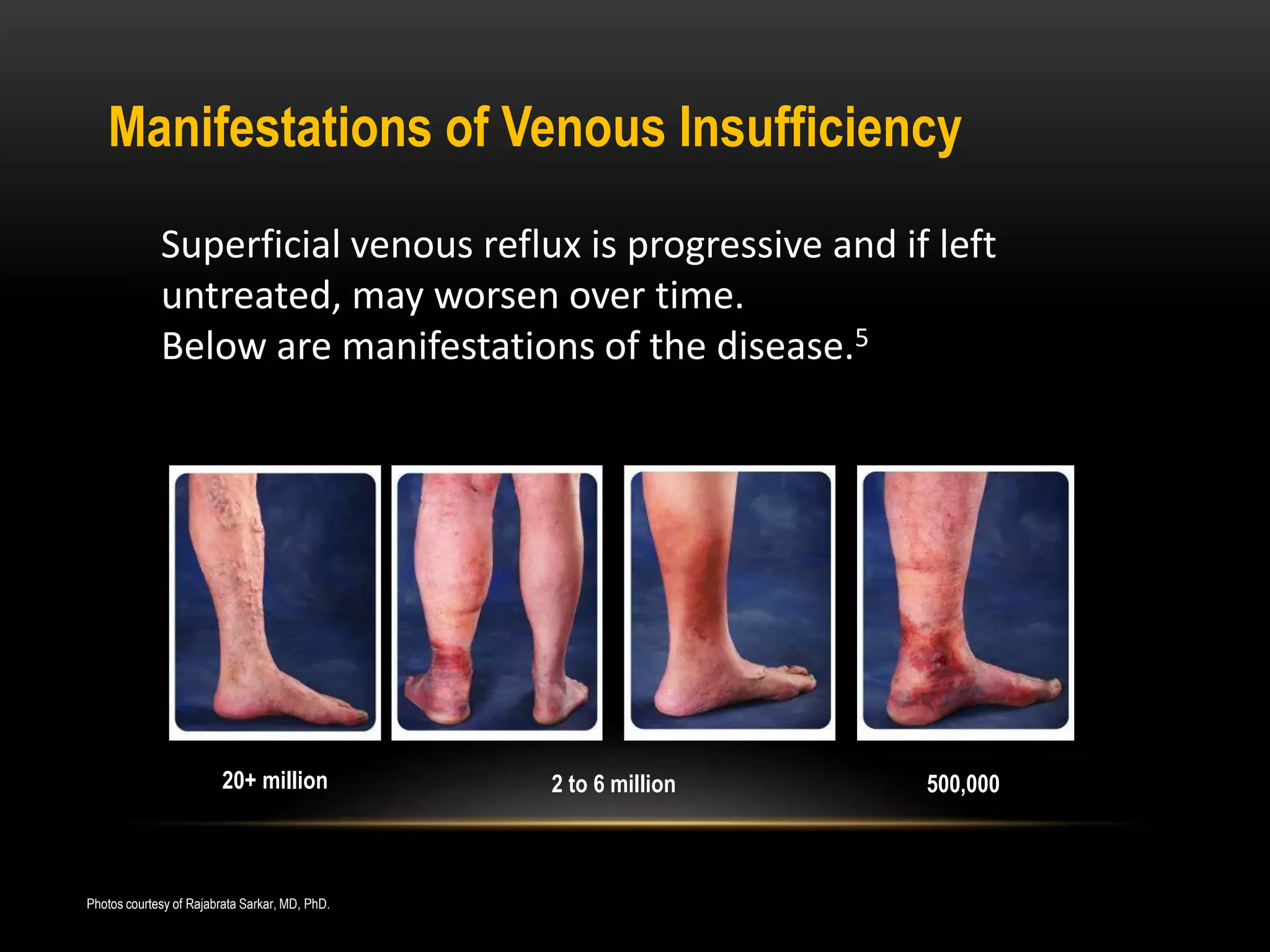Chronic Superficial Venous insufficiency | PPTX
