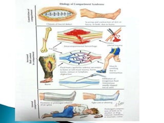 COMPARTMENT SYNDROME | PPT