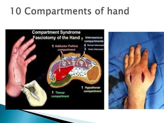 COMPARTMENT SYNDROME | PPT
