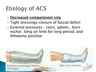 COMPARTMENT SYNDROME | PPT