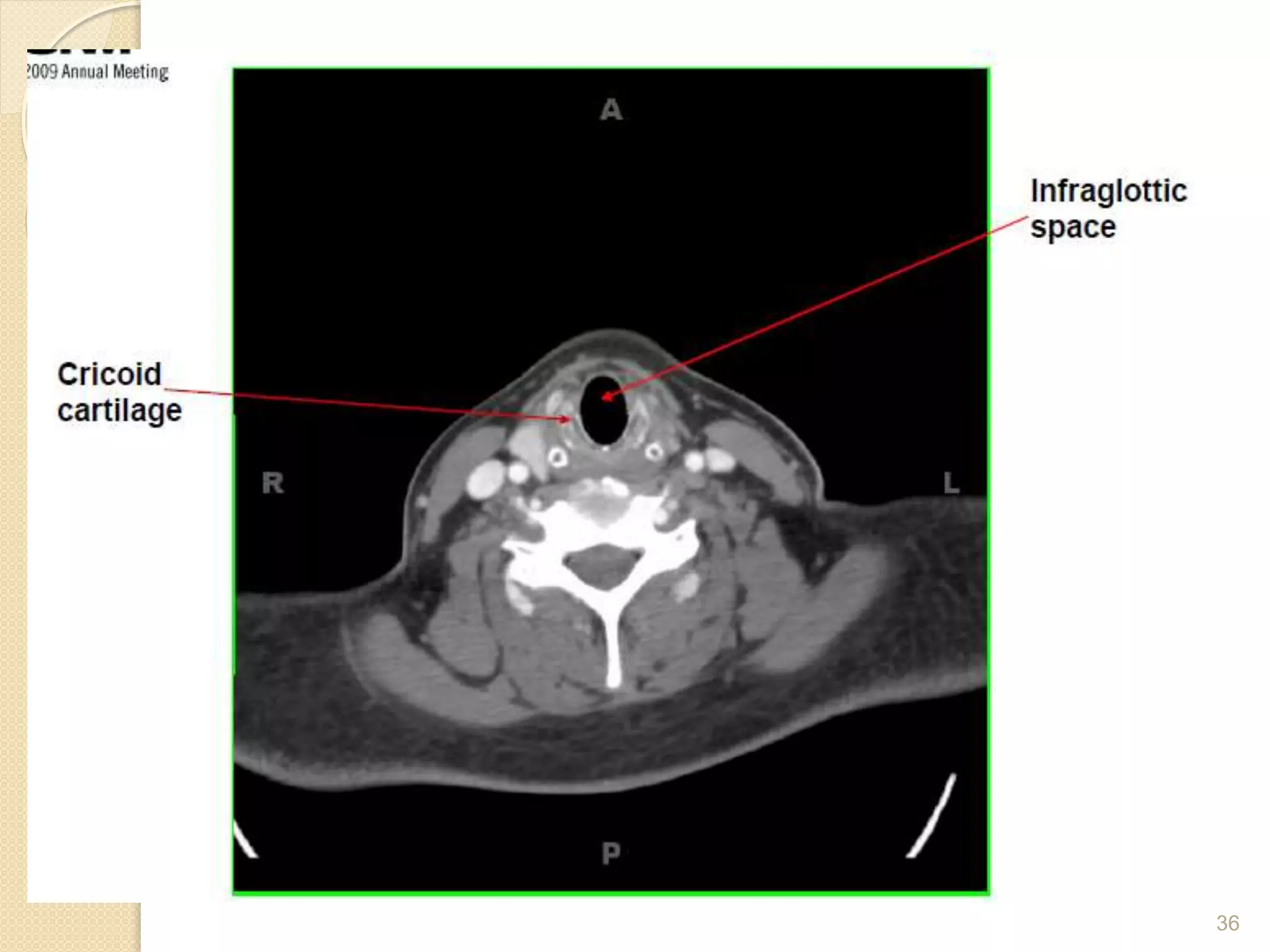 Ct ANATOMY HEAD AND NECK | PPTX