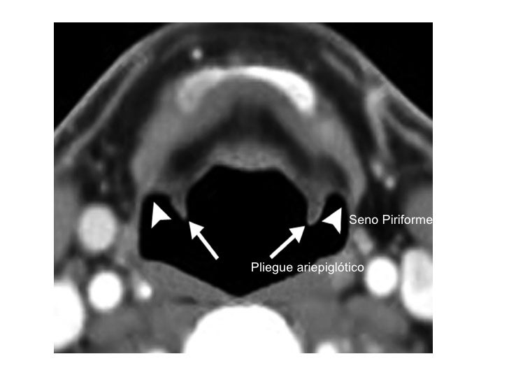 CT despues de laringectomía (APC)