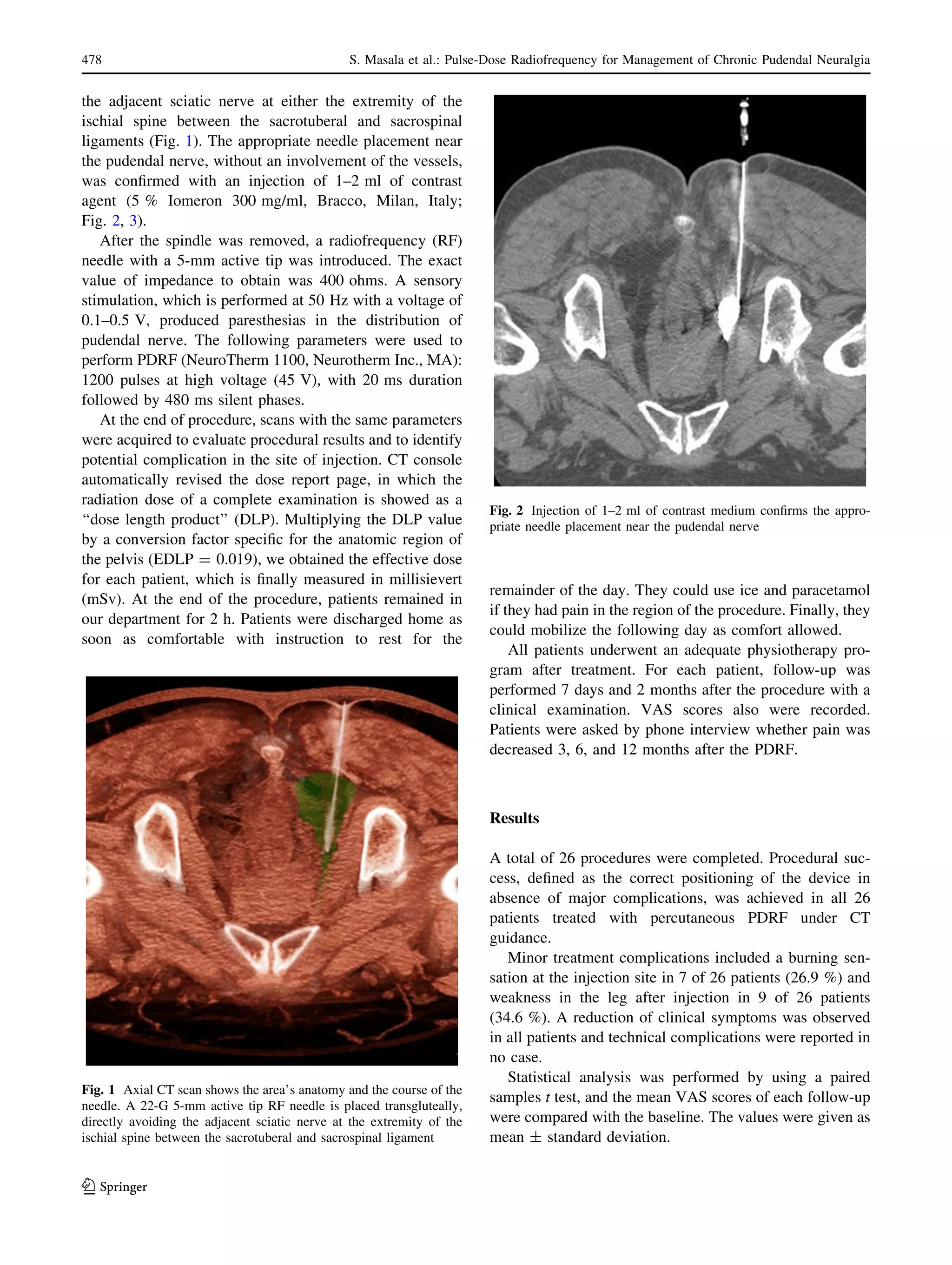 CT-Guided Percutaneous Pulse-Dose Radiofrequency for Pudendal Neuralgia | PDF | Physical Therapy ...