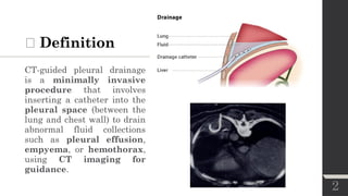 CT-Guided Pleural Drainage by Urooj Mushtaq bhat.pptx