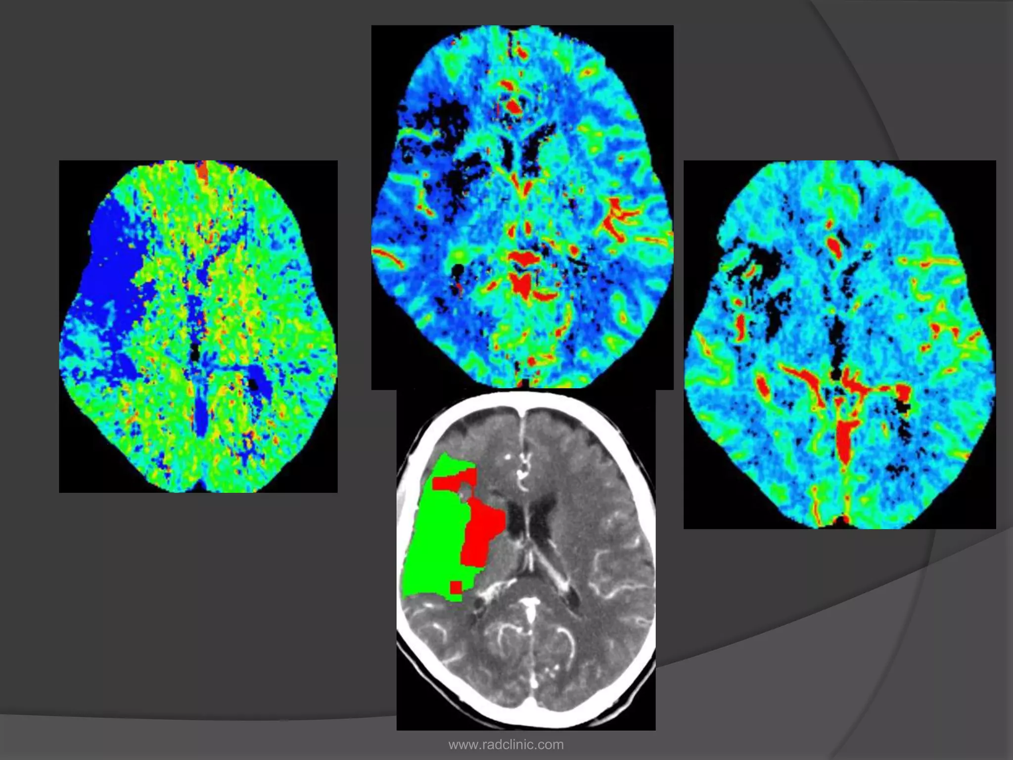 C T Imaging Of Acute Stroke Ppt Free Download