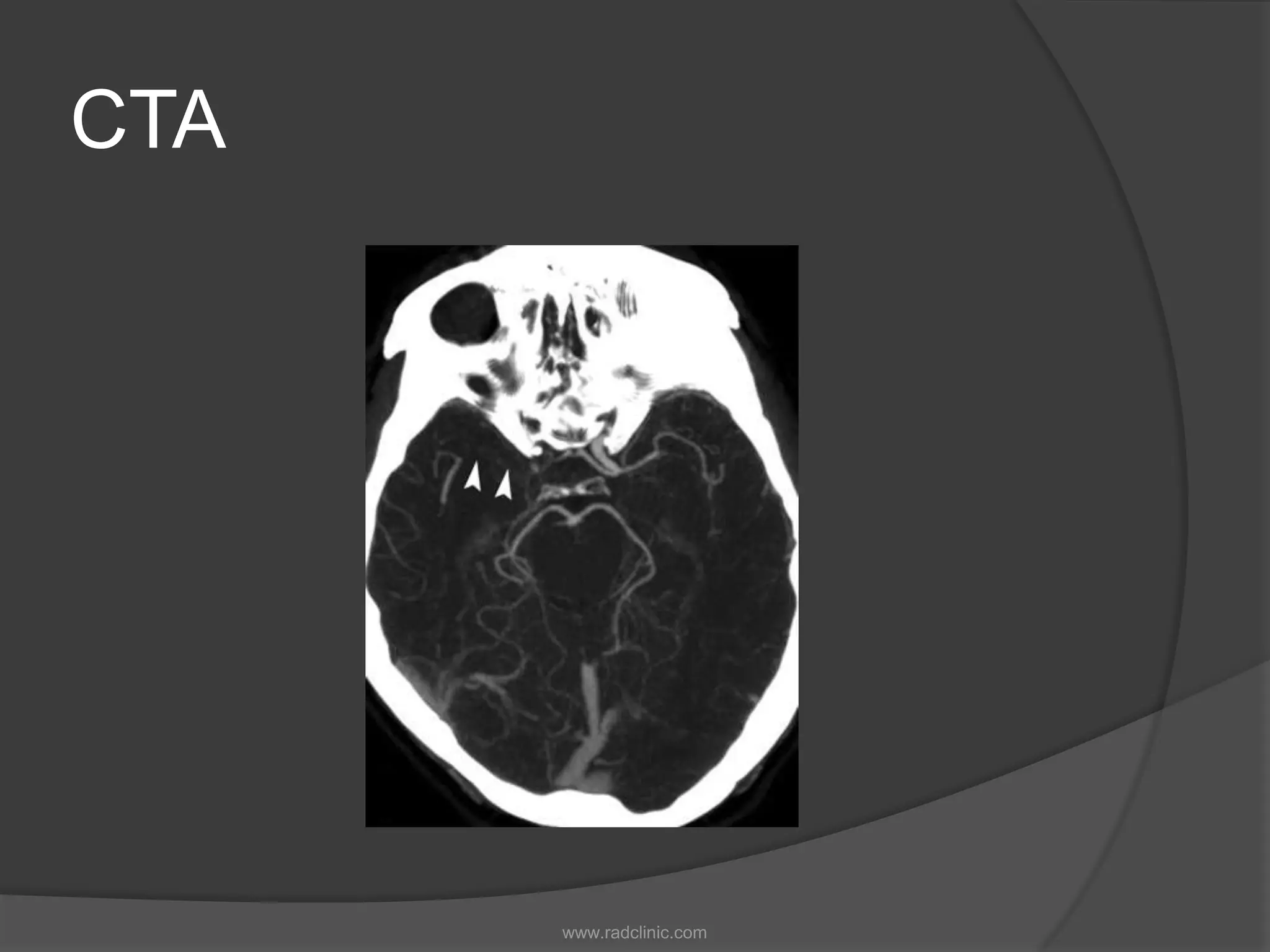 C T Imaging Of Acute Stroke Ppt Free Download