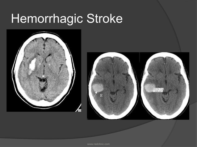C T Imaging Of Acute Stroke Ppt