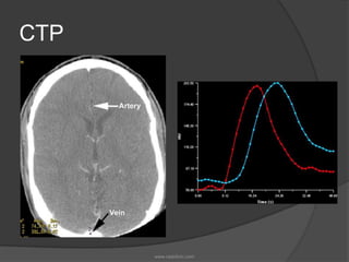 C T Imaging Of Acute Stroke | PPTX