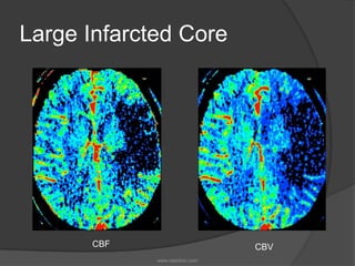 C T Imaging Of Acute Stroke | PPTX