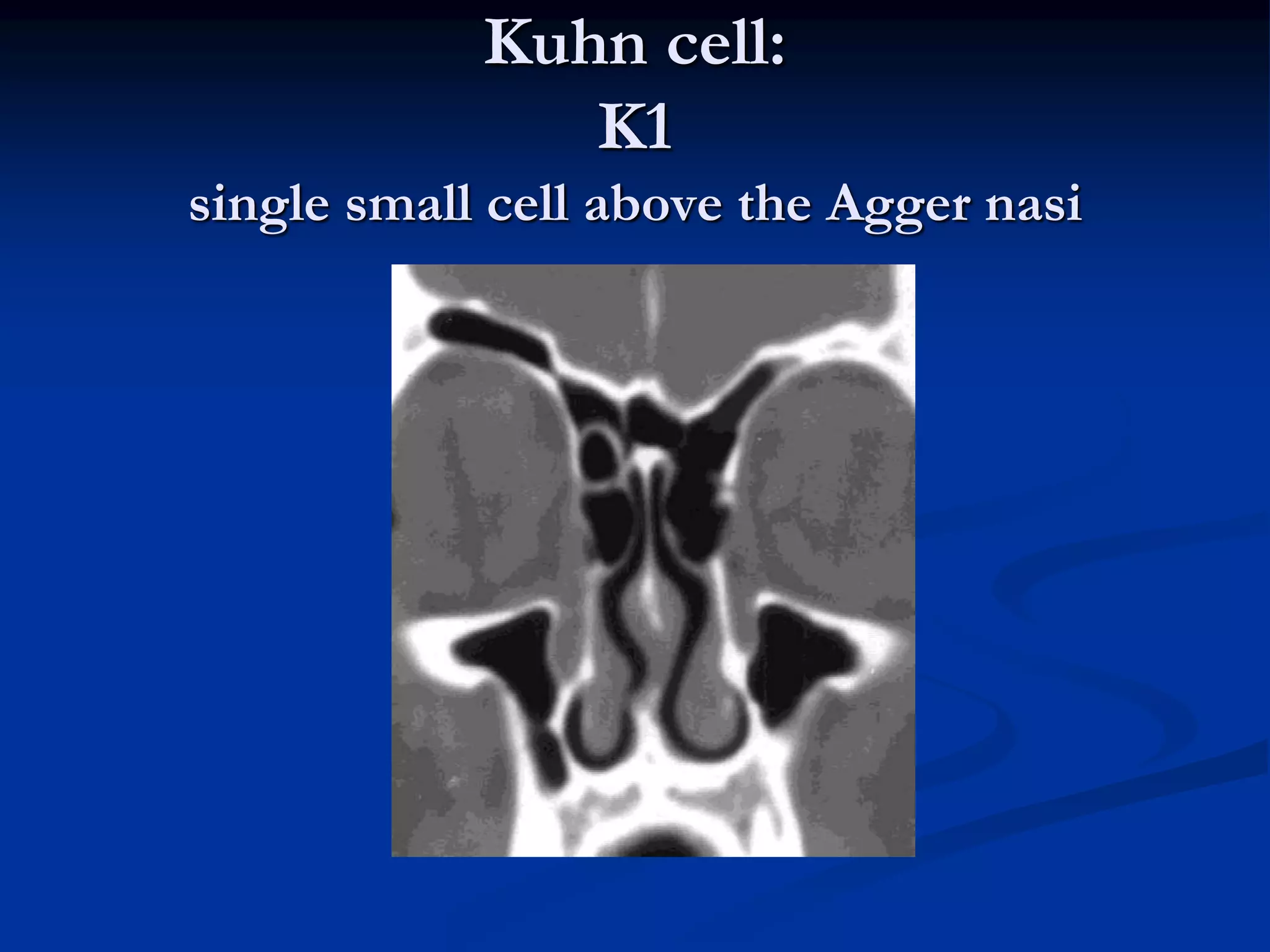 CT scan of nose and PNS | PPT