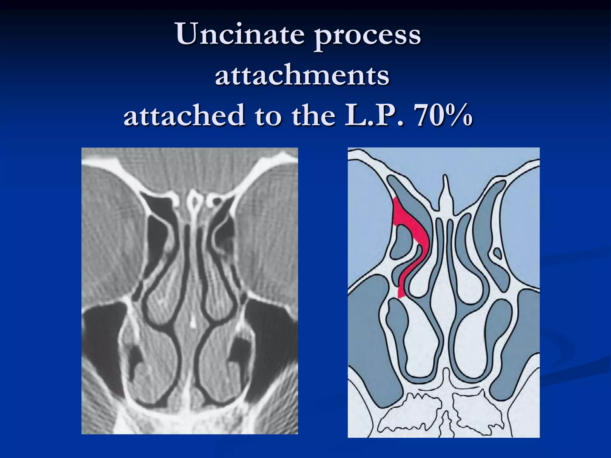 CT scan of nose and PNS | PPT