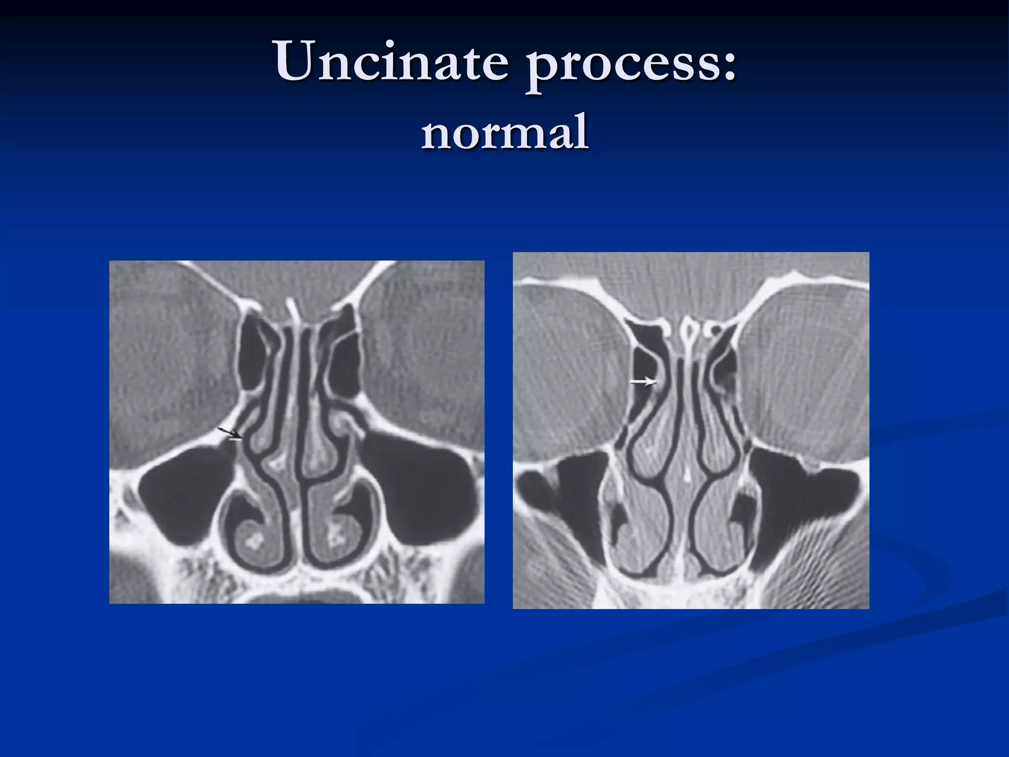 CT scan of nose and PNS | PPT