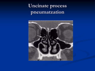 CT scan of nose and PNS | PPT
