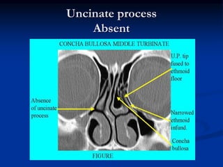 CT scan of nose and PNS | PPT