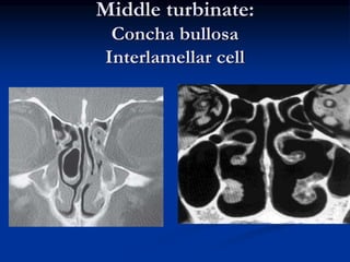 CT scan of nose and PNS | PPT
