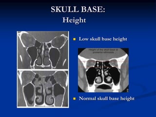 CT scan of nose and PNS | PPT