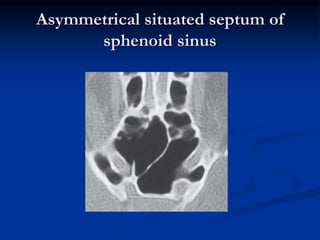 CT scan of nose and PNS | PPT
