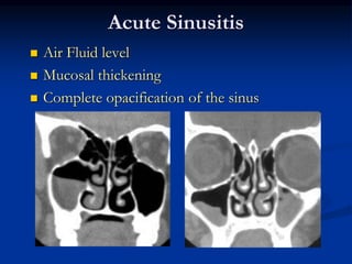 CT scan of nose and PNS | PPT