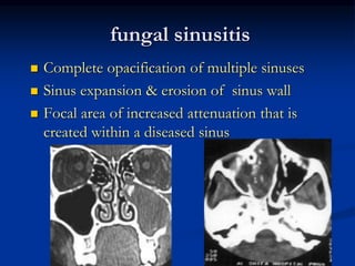 CT scan of nose and PNS | PPT