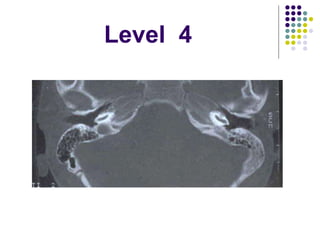 Ct scan of temporal bone 2nd lecture | PPT