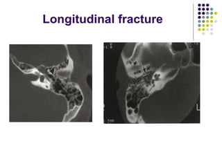 Ct scan of temporal bone 2nd lecture | PPT