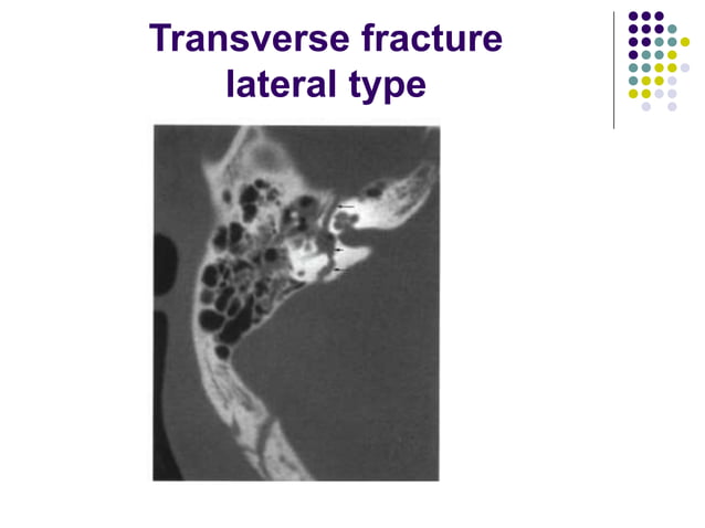 Ct scan of temporal bone 2nd lecture | PPT | Death, Injury, or Military ...