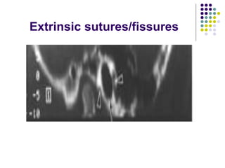 Ct scan of temporal bone 2nd lecture | PPT