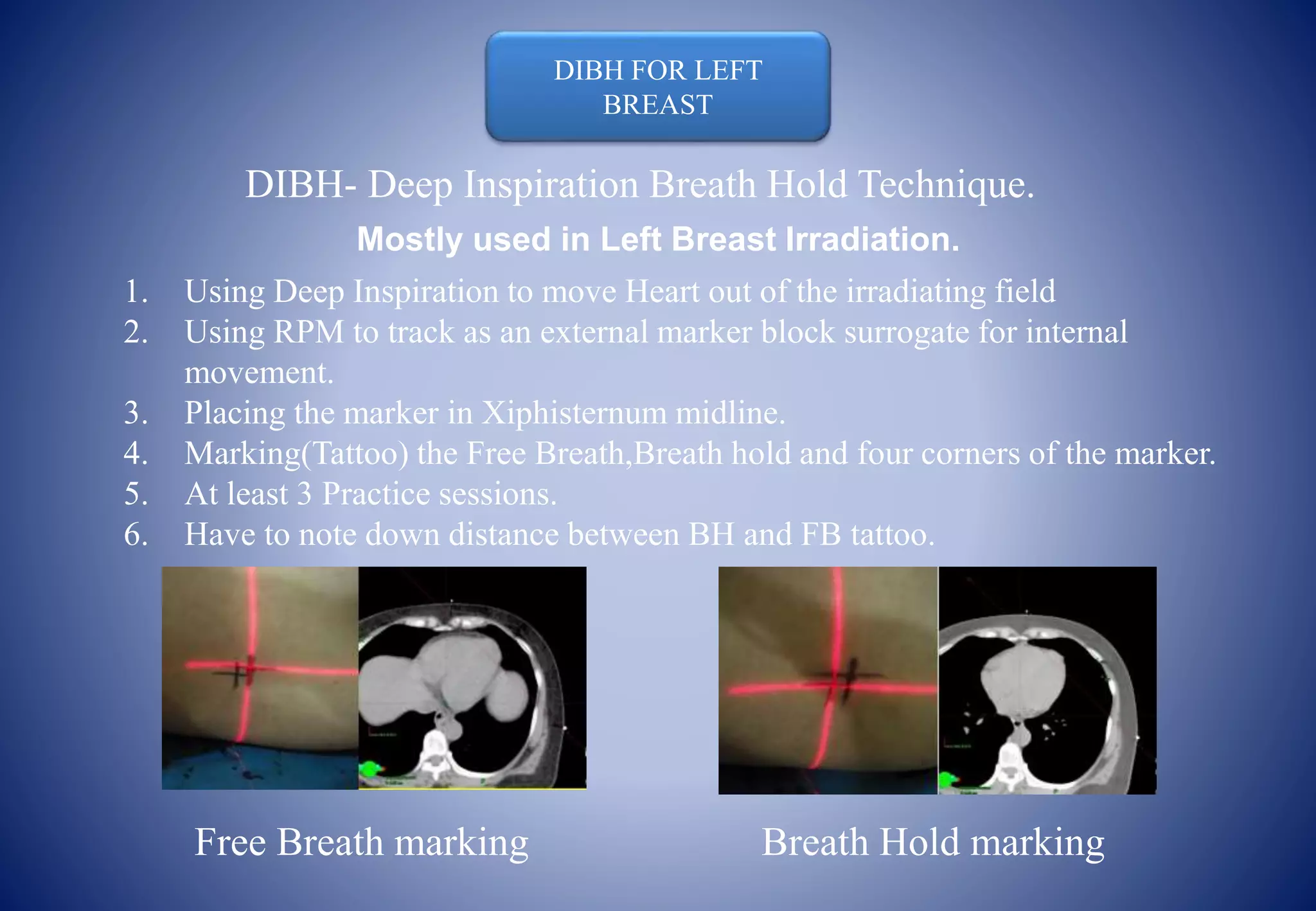 Importance of Planning CT Simulation(3D) in Radiothrapy/Radiation ...