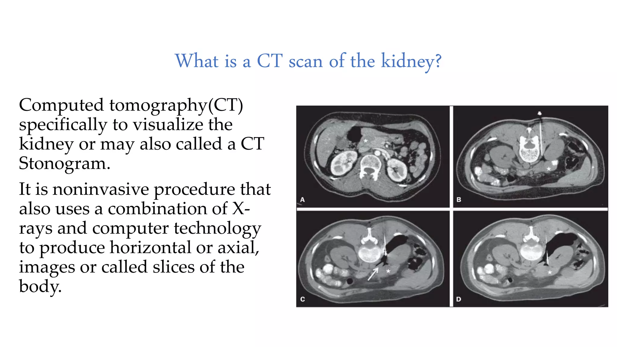 Ct stonogram-final-slide-share (Amponin & Carampatan) | PPTX