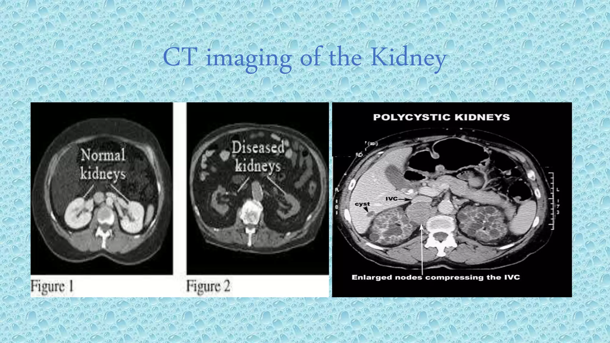 Ct stonogram-final-slide-share (Amponin & Carampatan) | PPTX