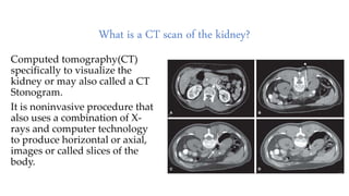 Ct stonogram-final-slide-share (Amponin & Carampatan) | PPTX